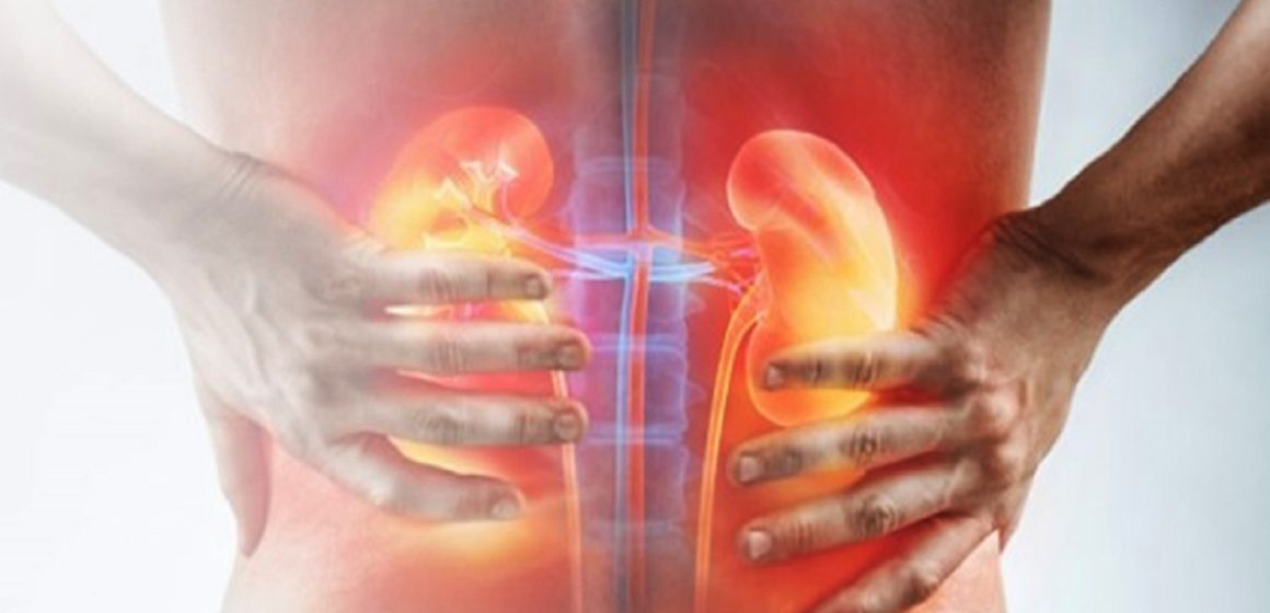 Entenda o que é cálculo renal, sintomas e tratamento - Bacana.news ...